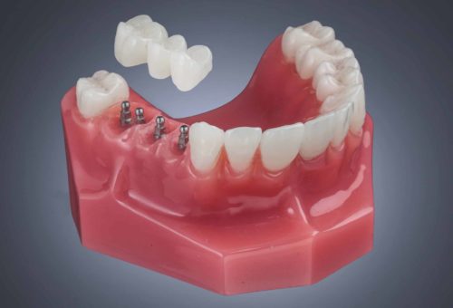 Explicación de los mini implantes dentales | Diana Rodriguez, DMD