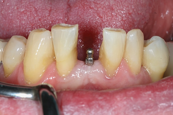 Explicación del proceso de mini-implante dental | Diana Rodriguez, DMD