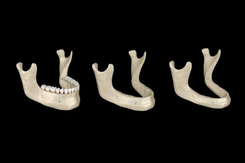 Stages of Bone Loss Explained | Mini Dental Implants in Union City