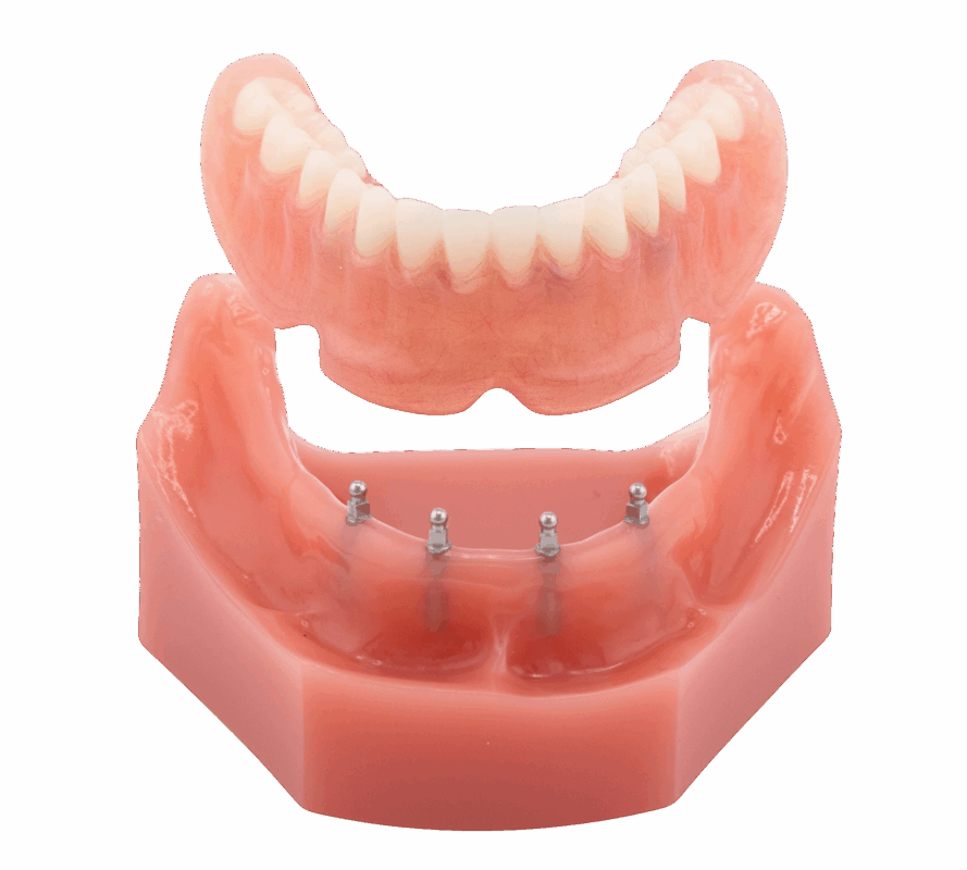 Snap-In Dentures in Union City, NJ | How Mini Dental Implants Stabilize ...