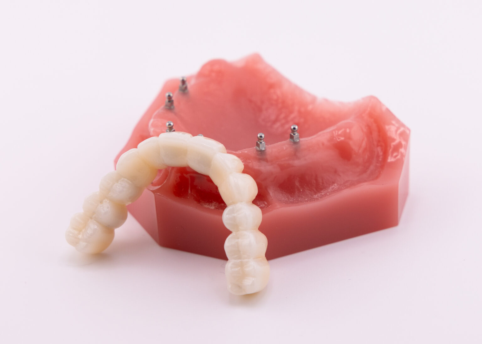 Full Arch Dental Implants in Union City, NJ | Free Consultations